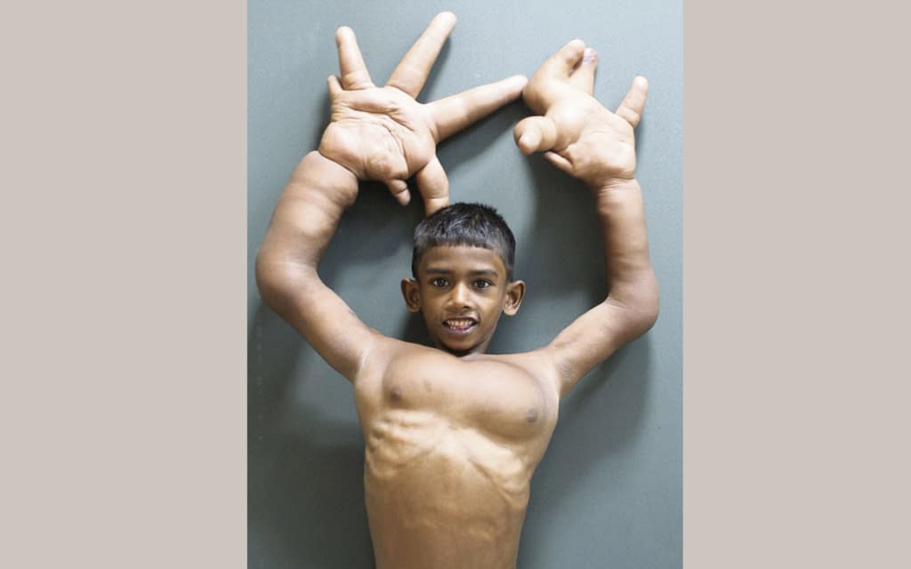 Hope for Indian boy with the world's biggest hands...